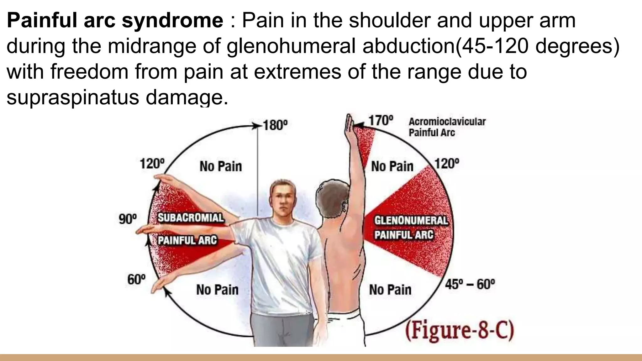 Shoulder impingement syndrome | PPTX