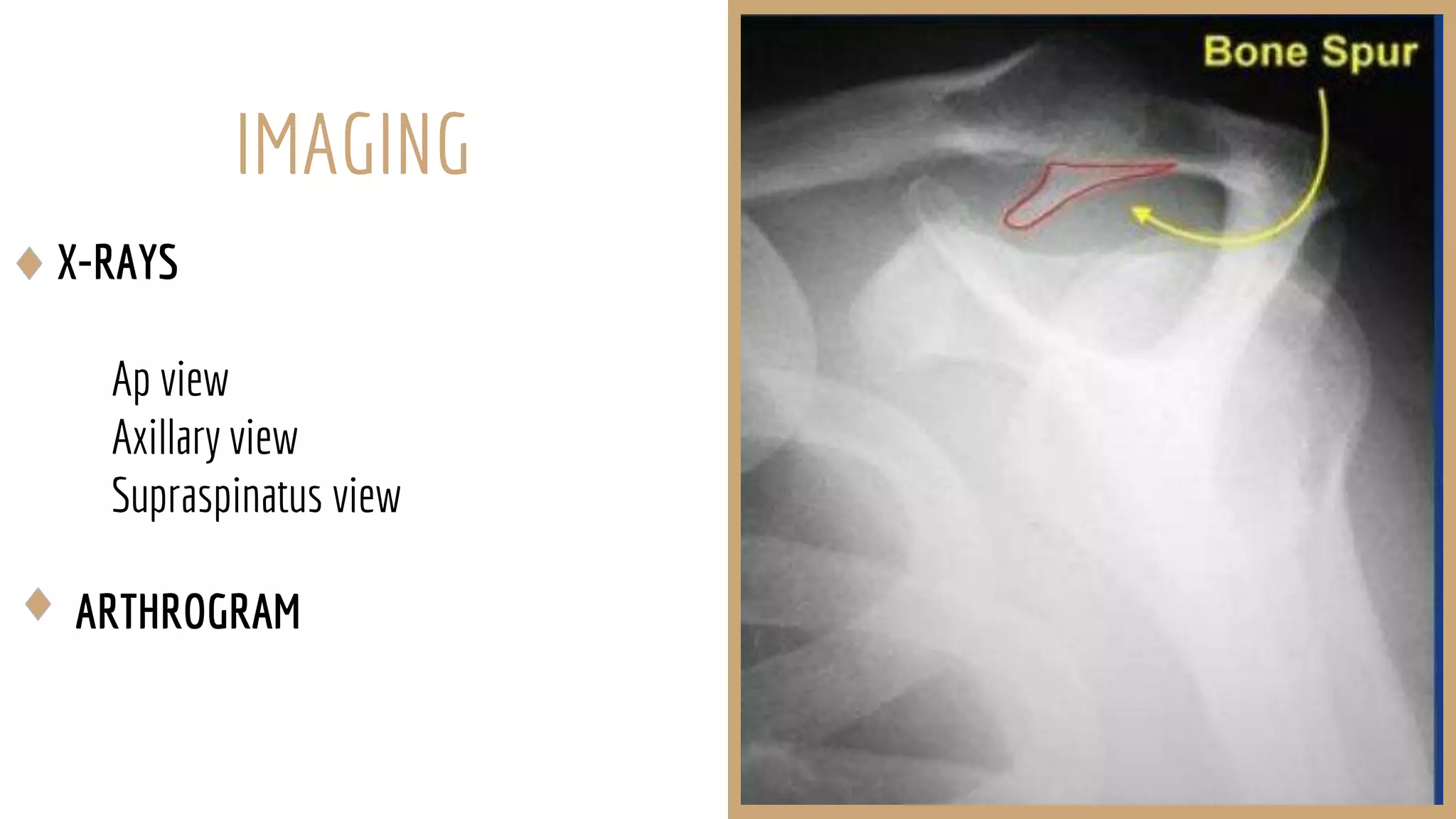 Shoulder impingement syndrome | PPTX