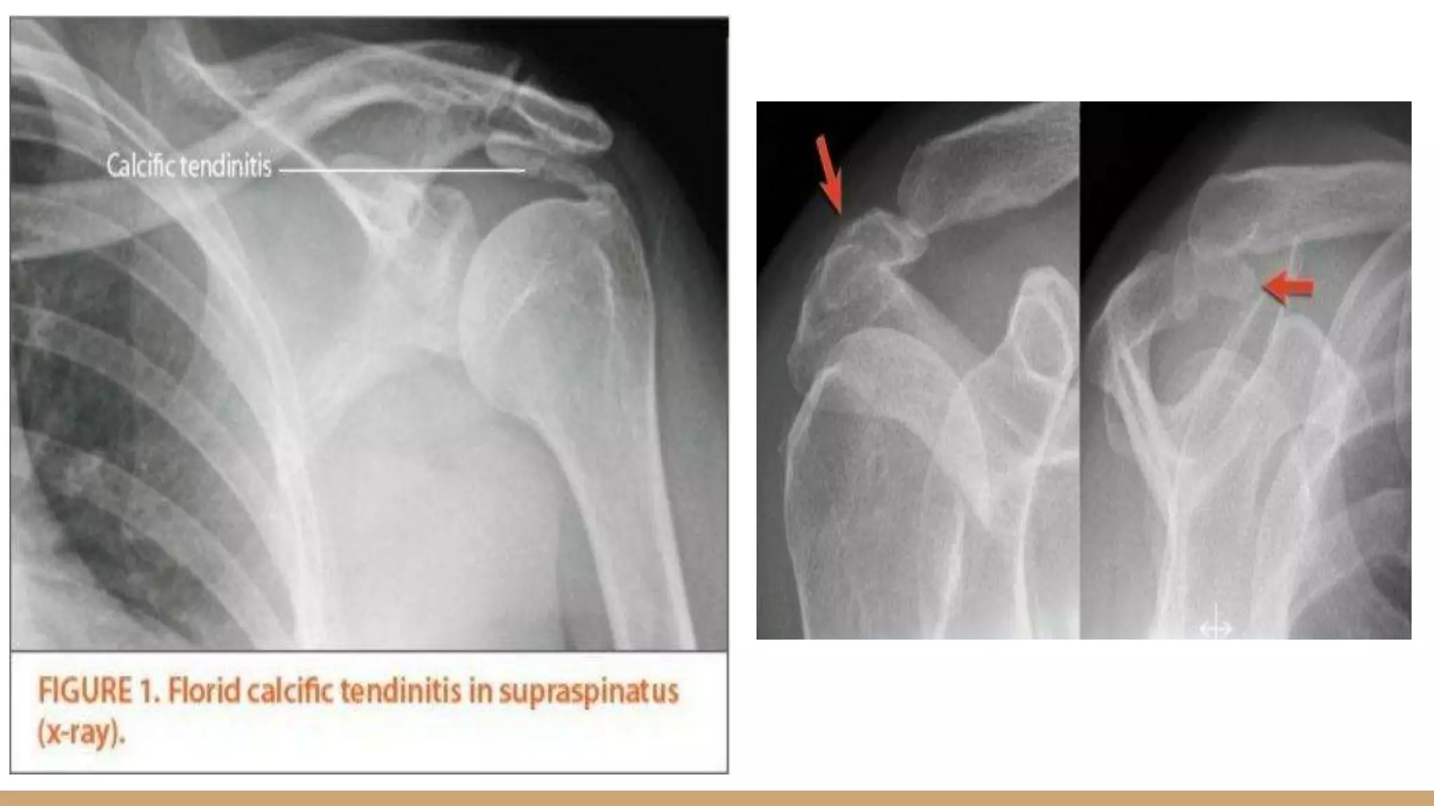 Shoulder impingement syndrome | PPTX
