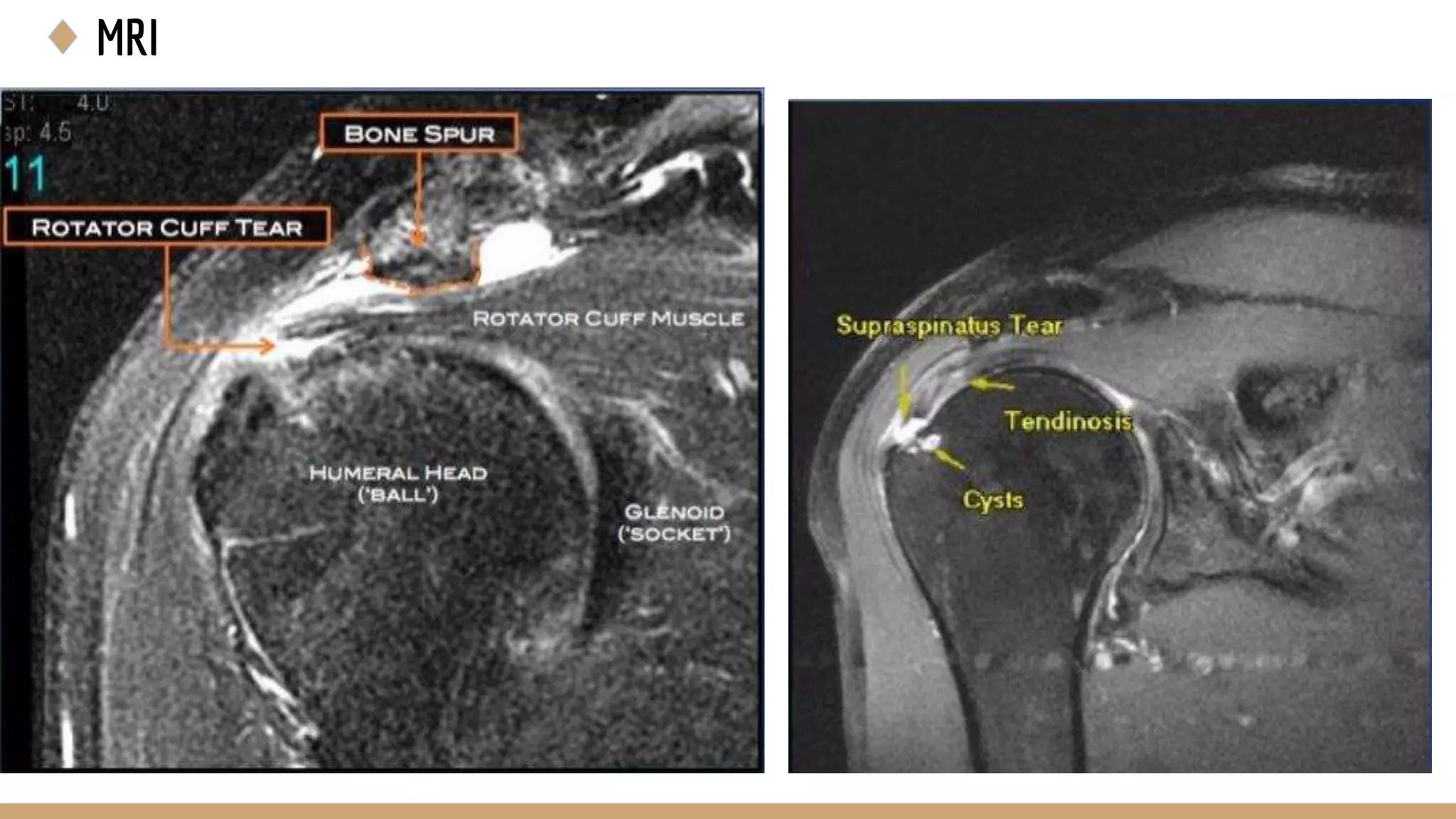 Shoulder impingement syndrome | PPTX