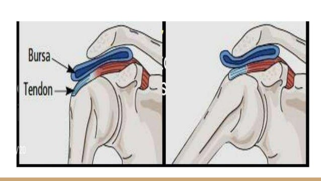 Shoulder impingement syndrome | PPTX