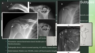 shoulder impingement in sports physiotherapy | PPTX