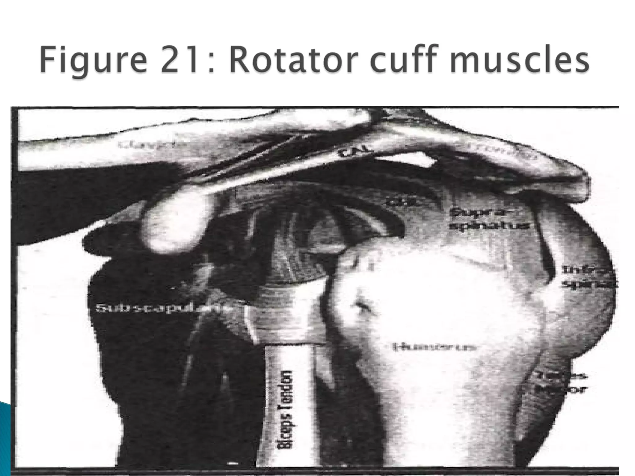 Shoulder impingement syndrome | PPT