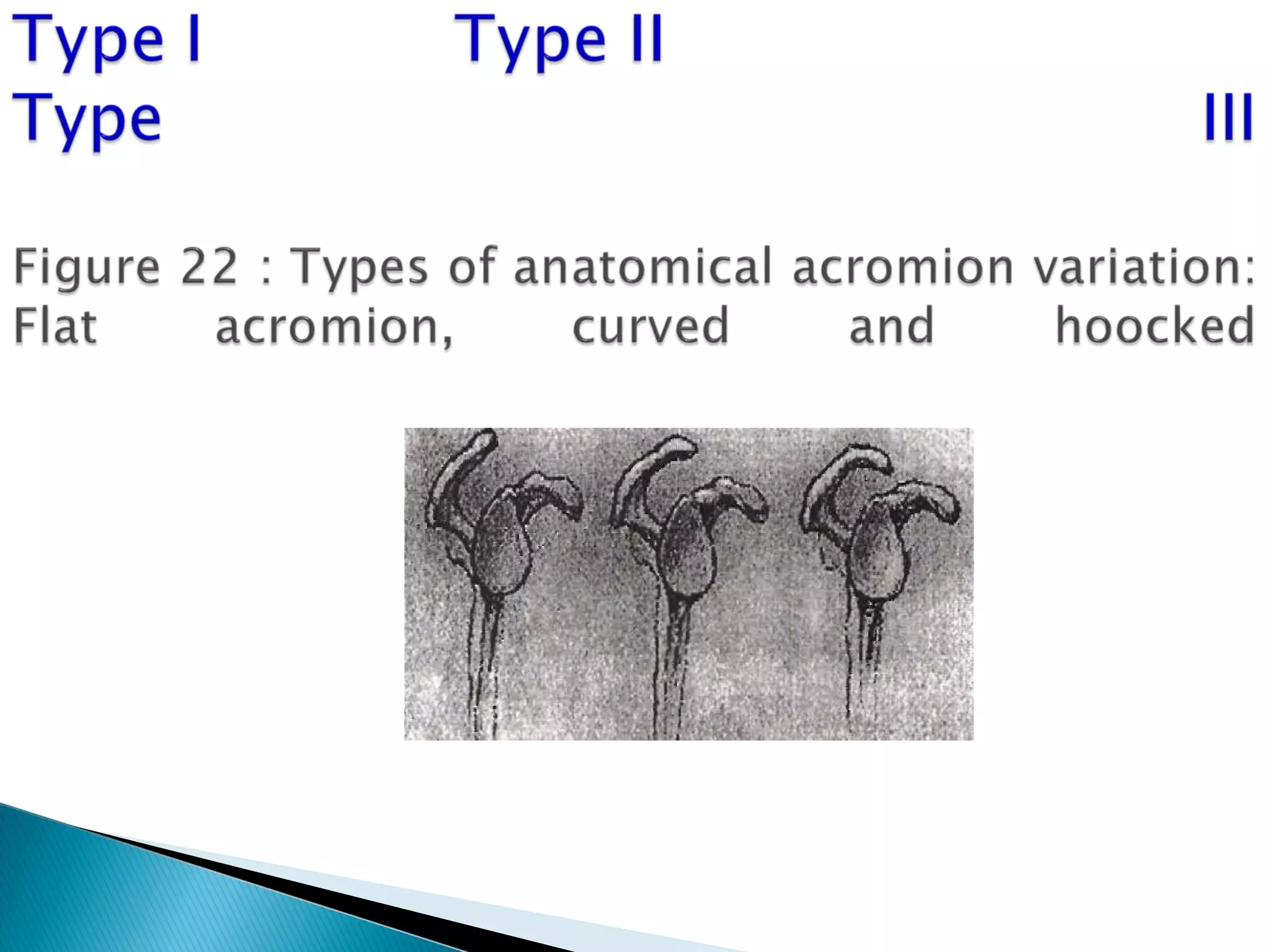 Shoulder impingement syndrome | PPT