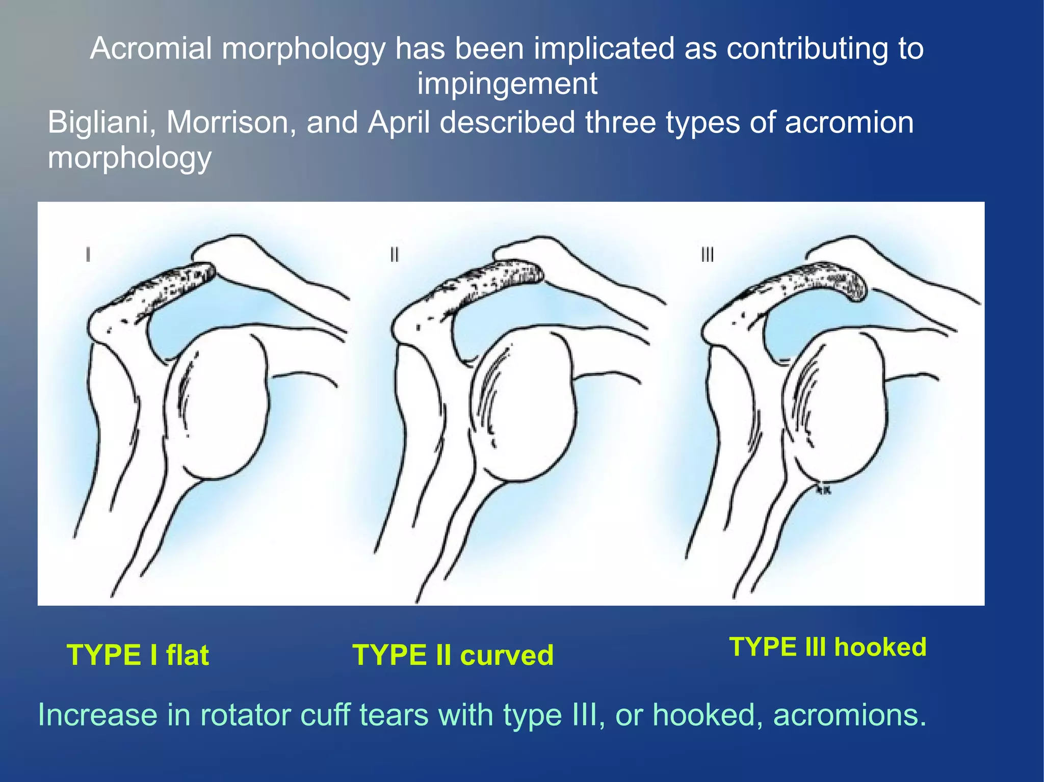 Shoulder impingement syndrome | ODP