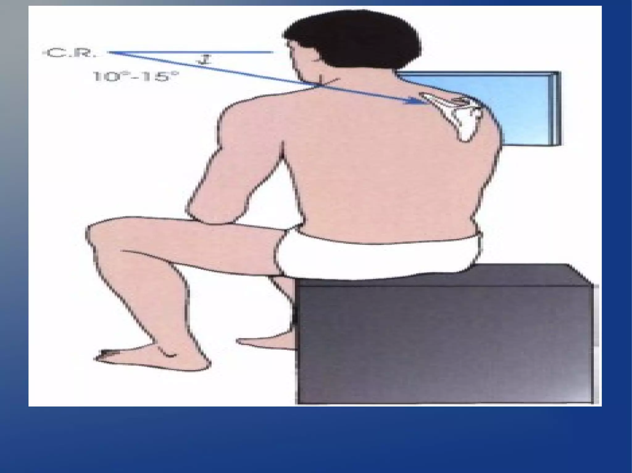 Shoulder impingement syndrome | ODP