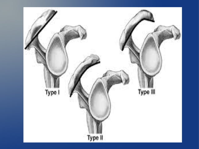 Shoulder impingement syndrome | ODP