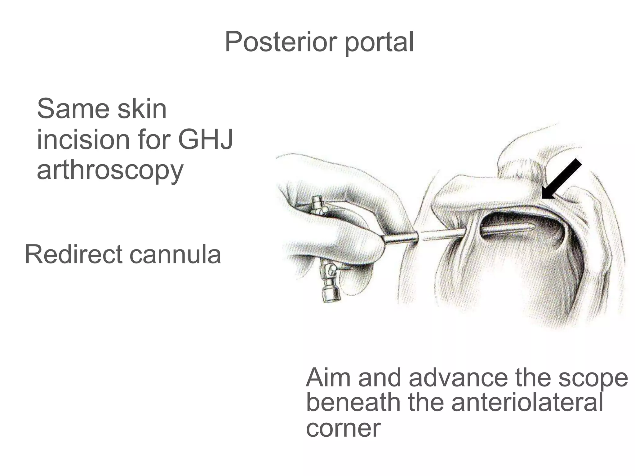 Shoulder impingement syndrome | PPTX