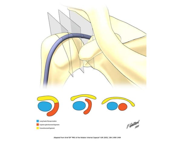 Shoulder impingement syndrome | PPTX