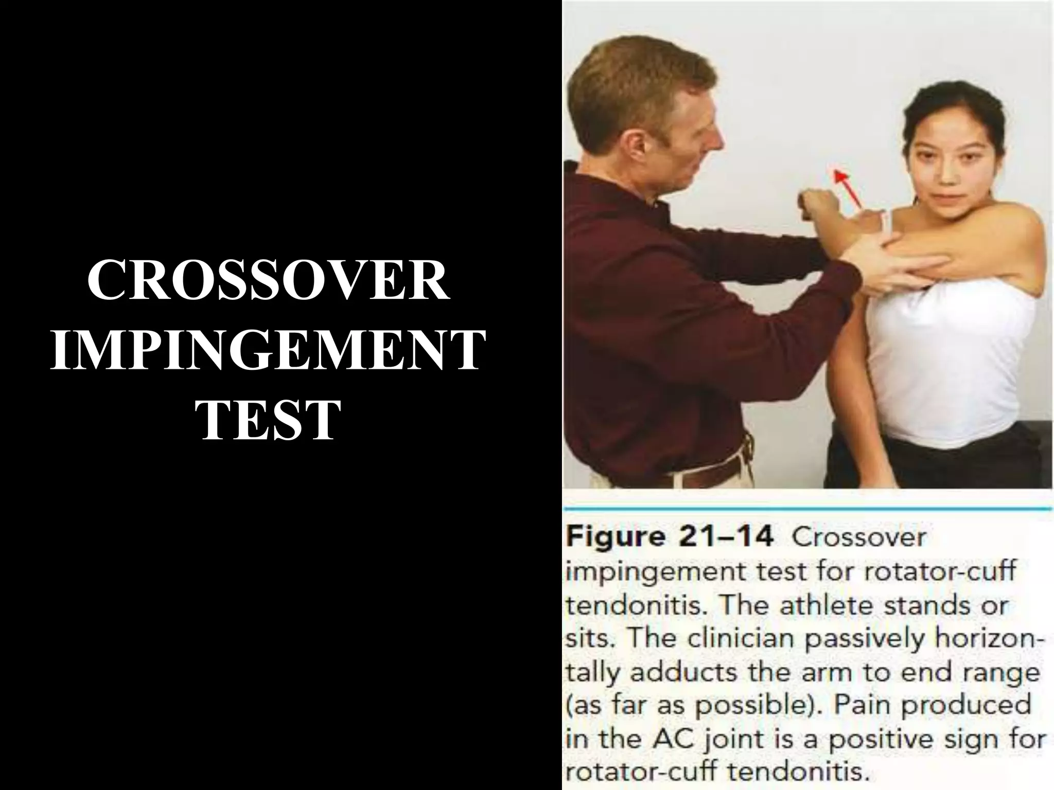 Shoulder impingement syndrome | PPTX