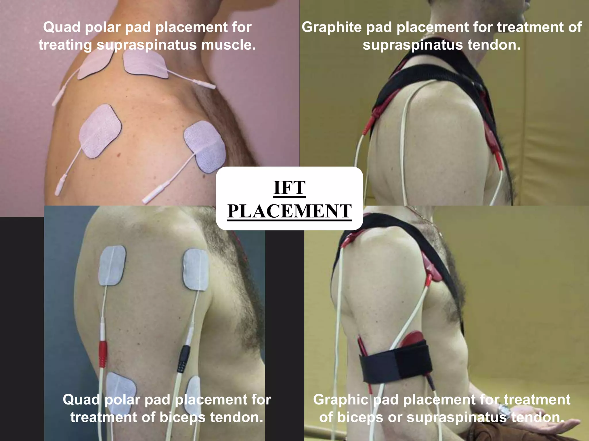 Shoulder impingement syndrome | PPTX