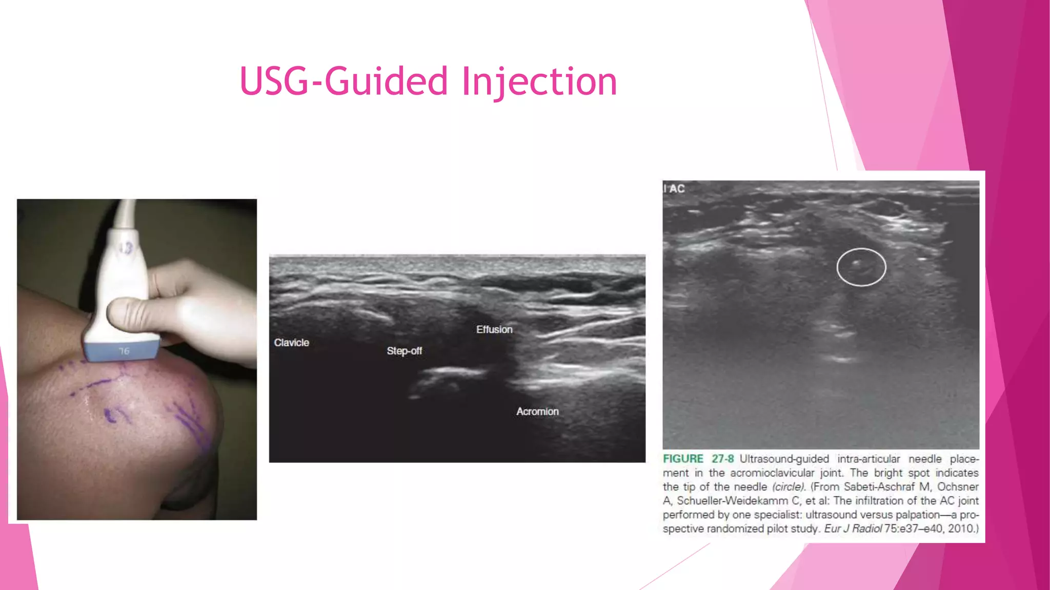 Shoulder Injection | PPTX