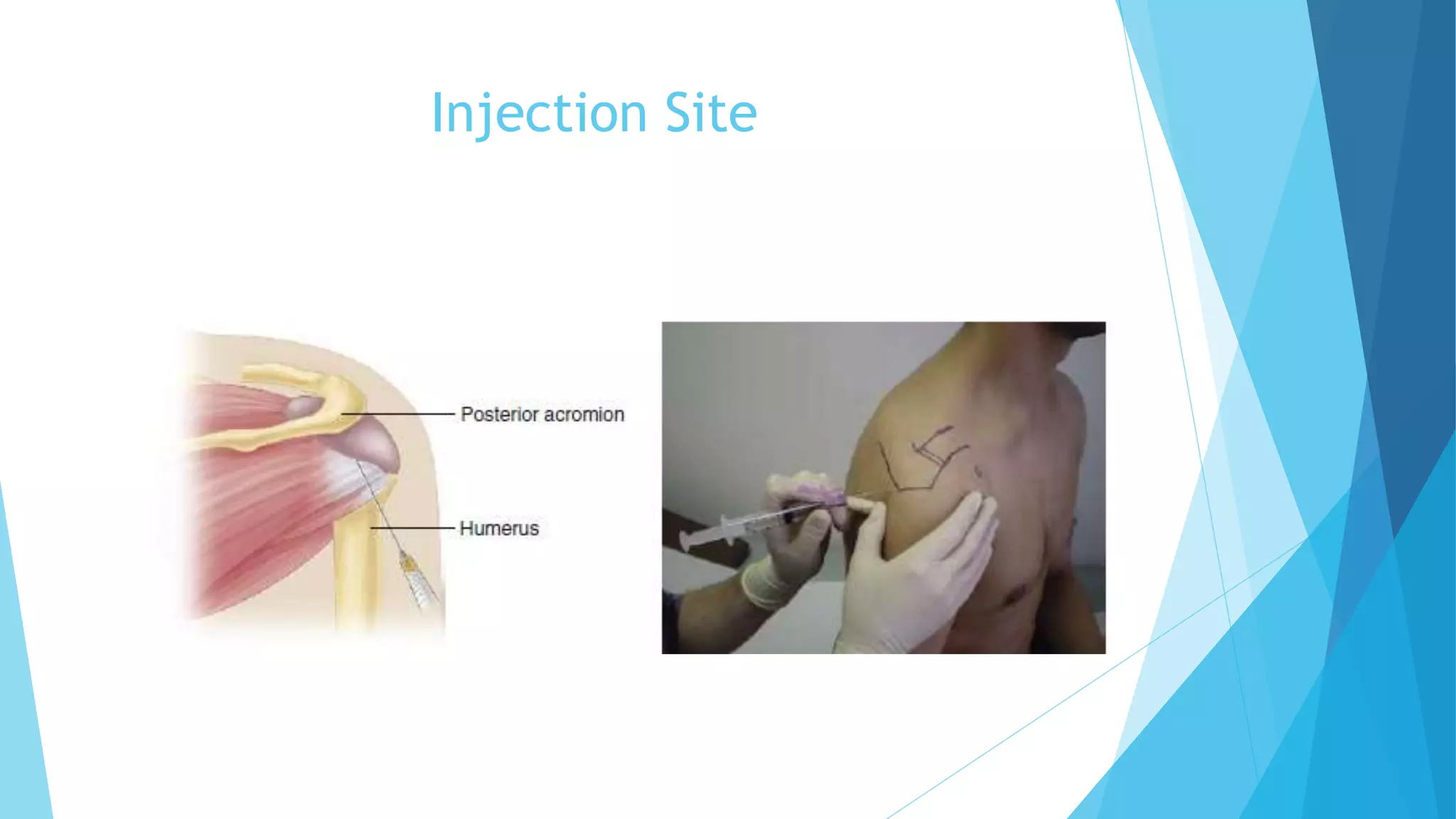 Shoulder Injection | PPTX