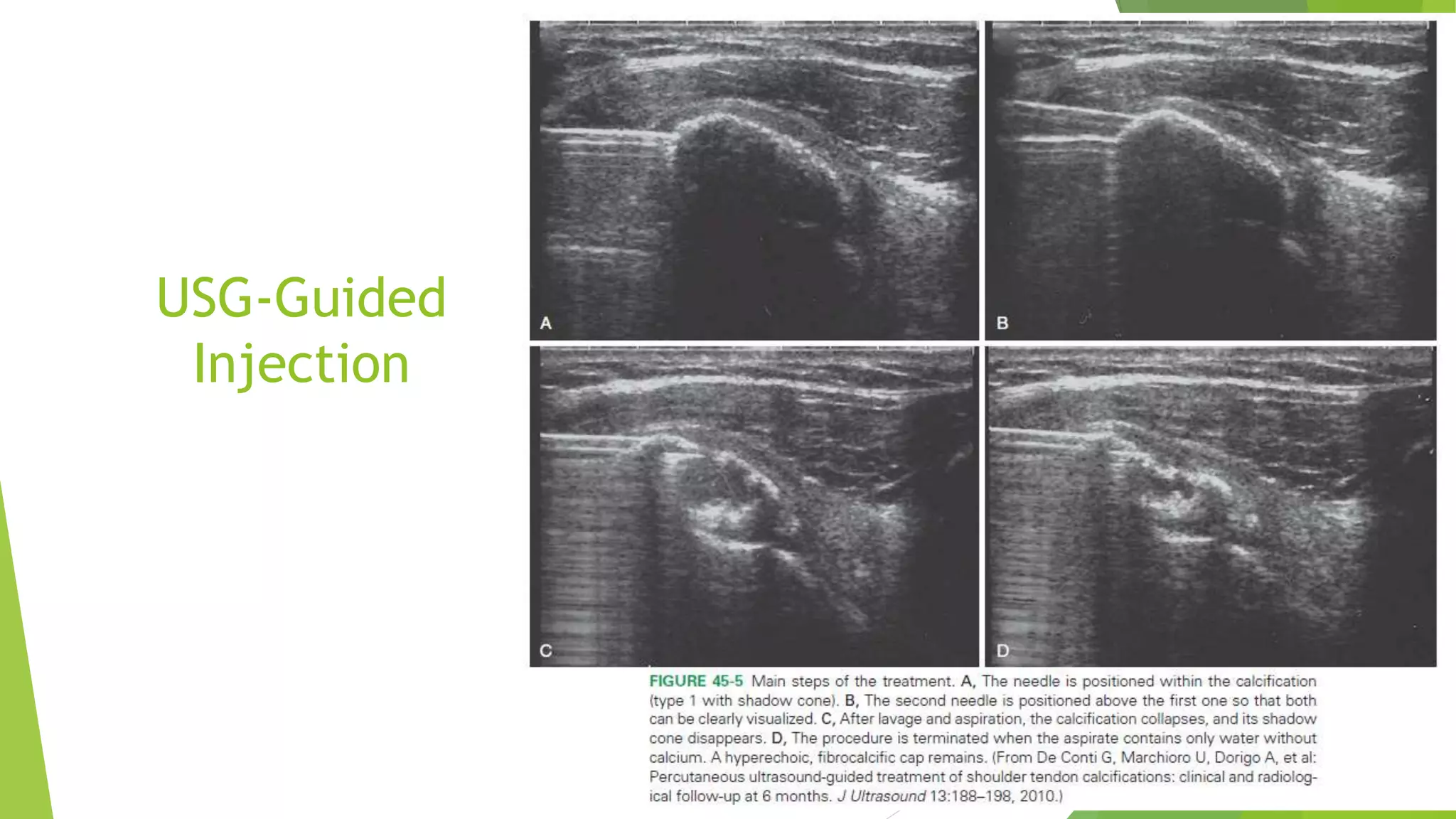 Shoulder Injection | PPTX