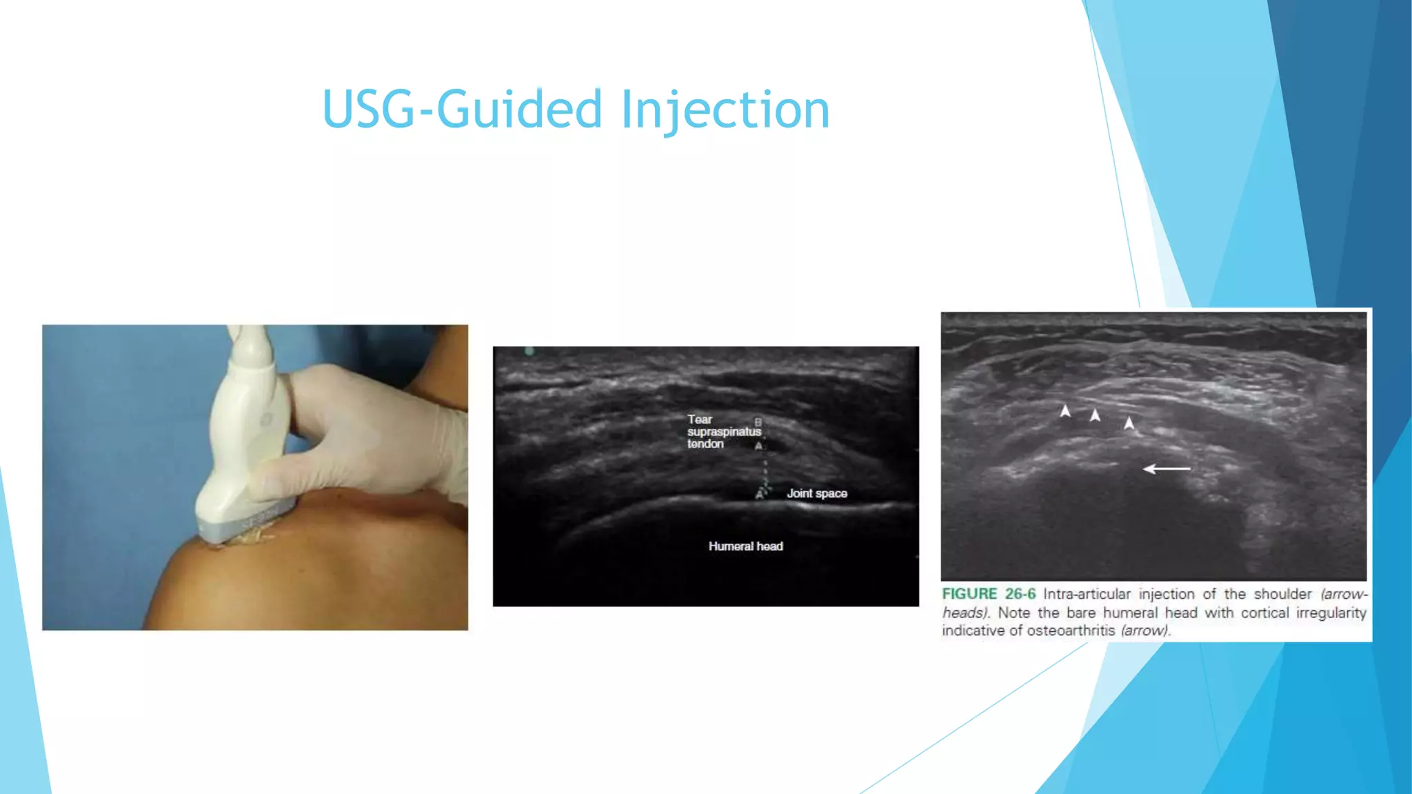 Shoulder Injection | PPTX