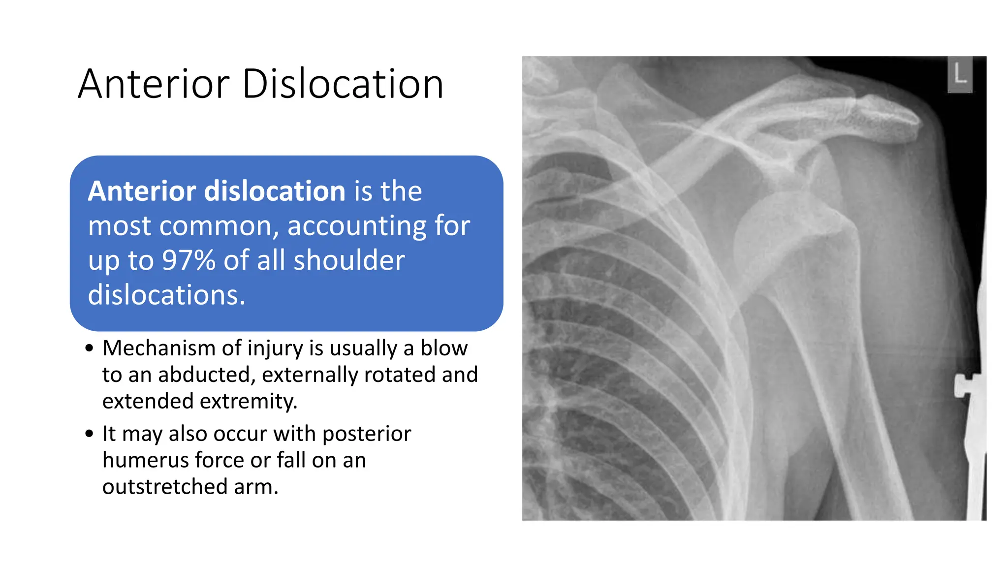 Shoulder Injury klasifikasi dan terapi.pptx