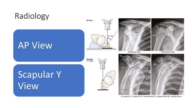 Shoulder Injury klasifikasi dan terapi.pptx