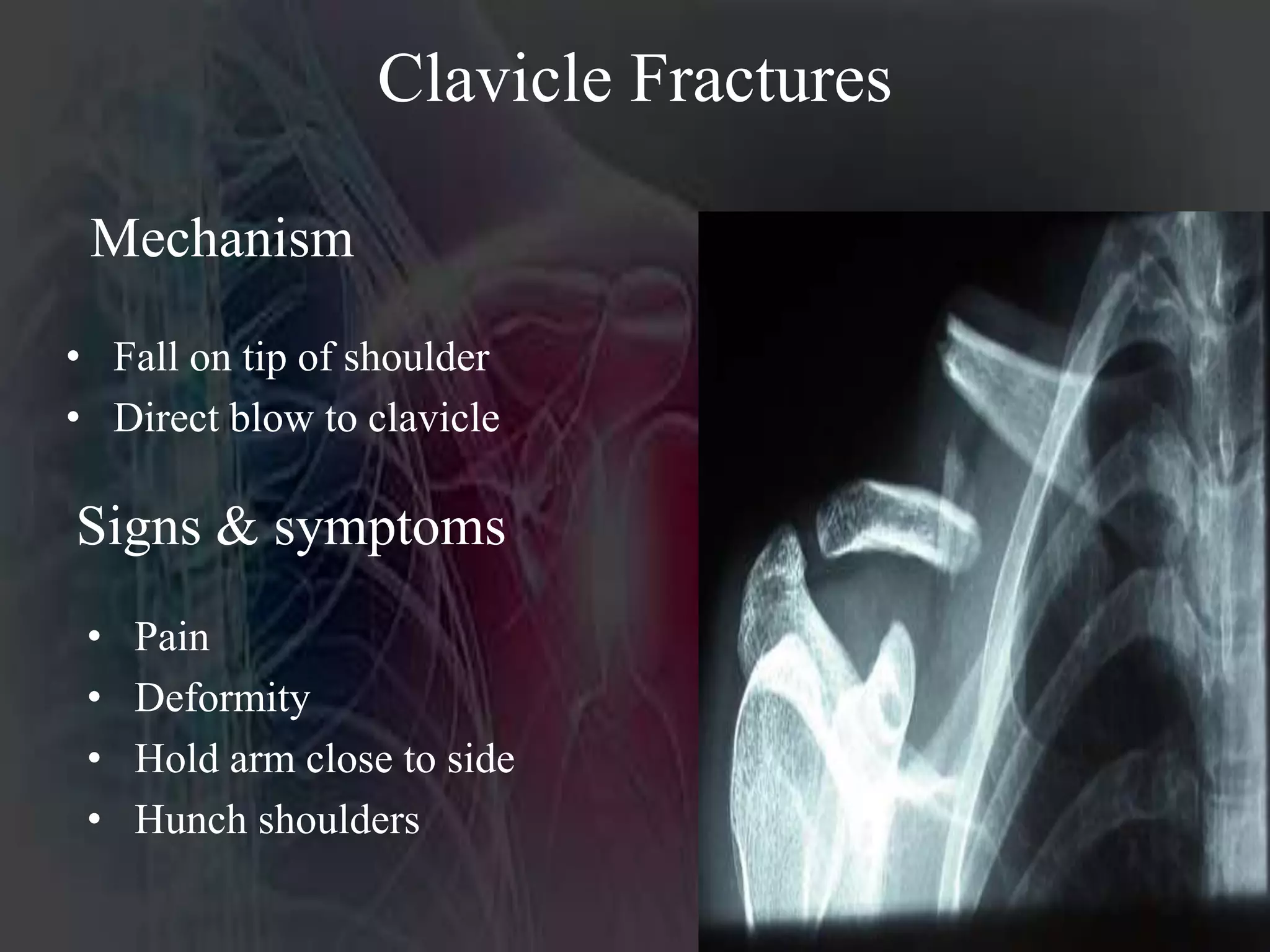 Shoulder injury and back pain | PPTX