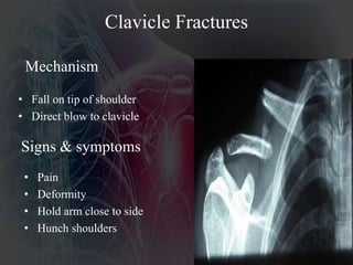 Shoulder injury and back pain | PPTX