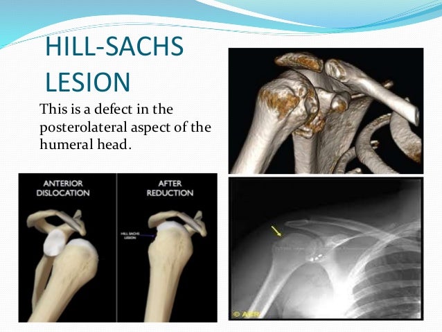 Shoulder Instability