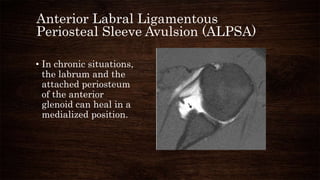 Shoulder instability | PPTX