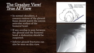 Shoulder instability | PPTX