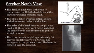 Shoulder instability | PPTX