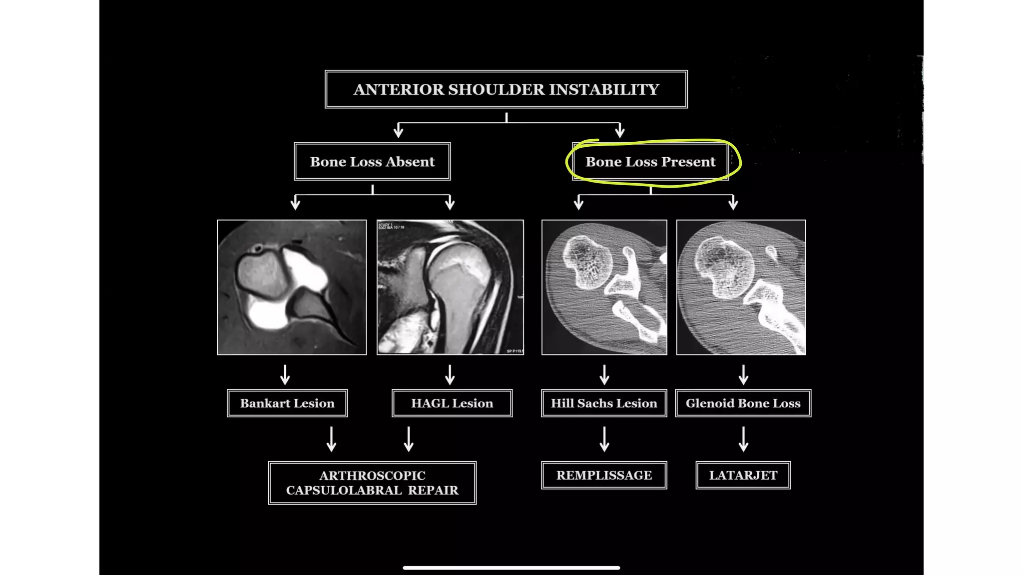 Shoulder instability | PPTX