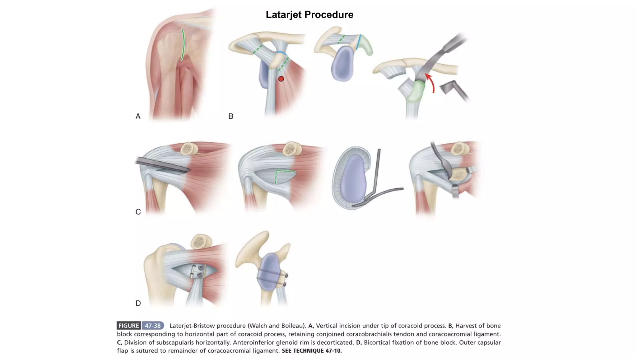 Shoulder instability | PPTX
