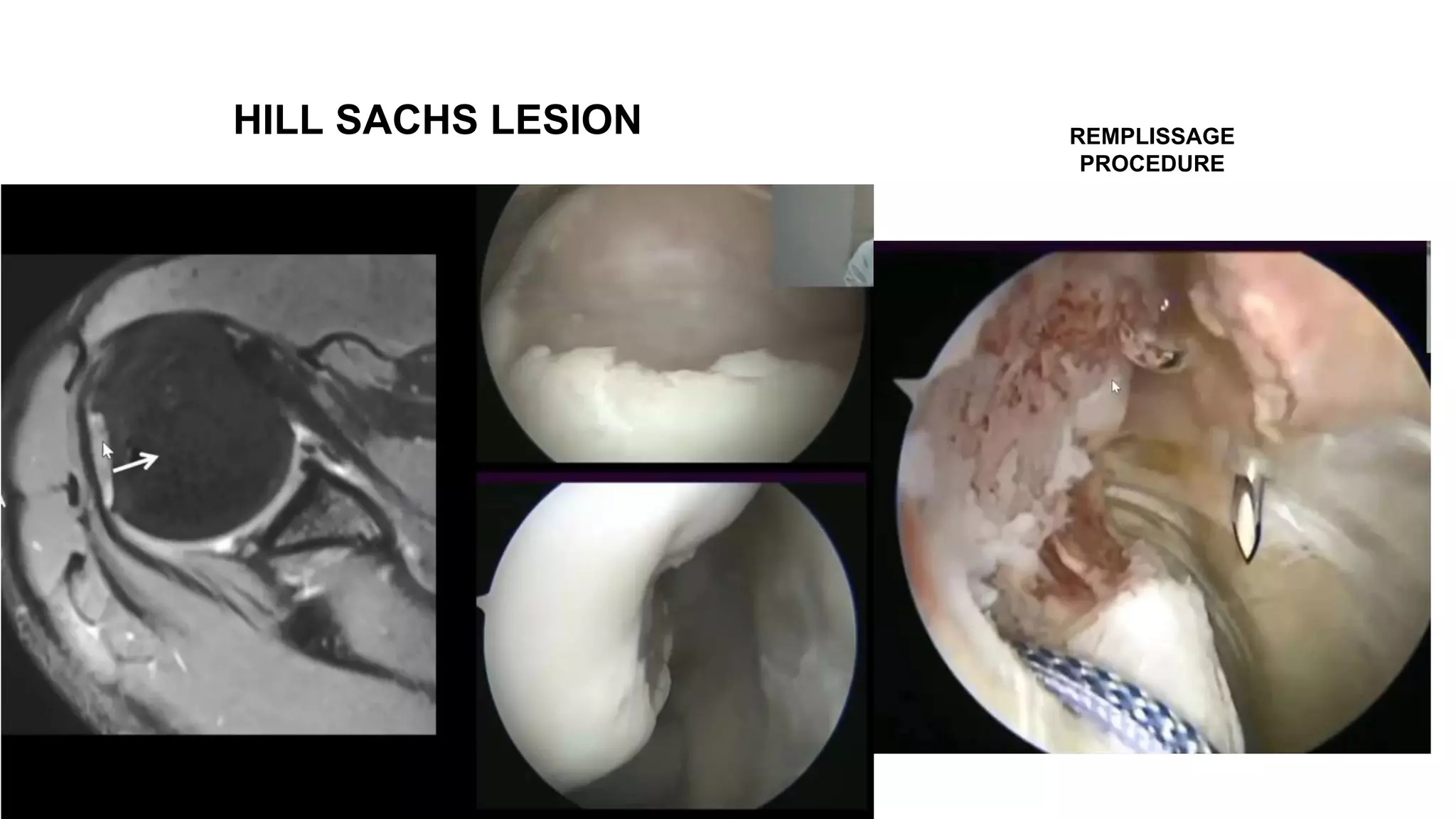 Shoulder instability | PPTX
