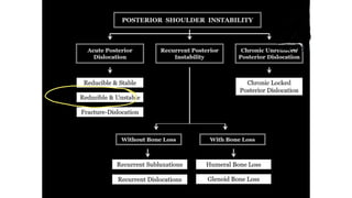 Shoulder instability | PPTX
