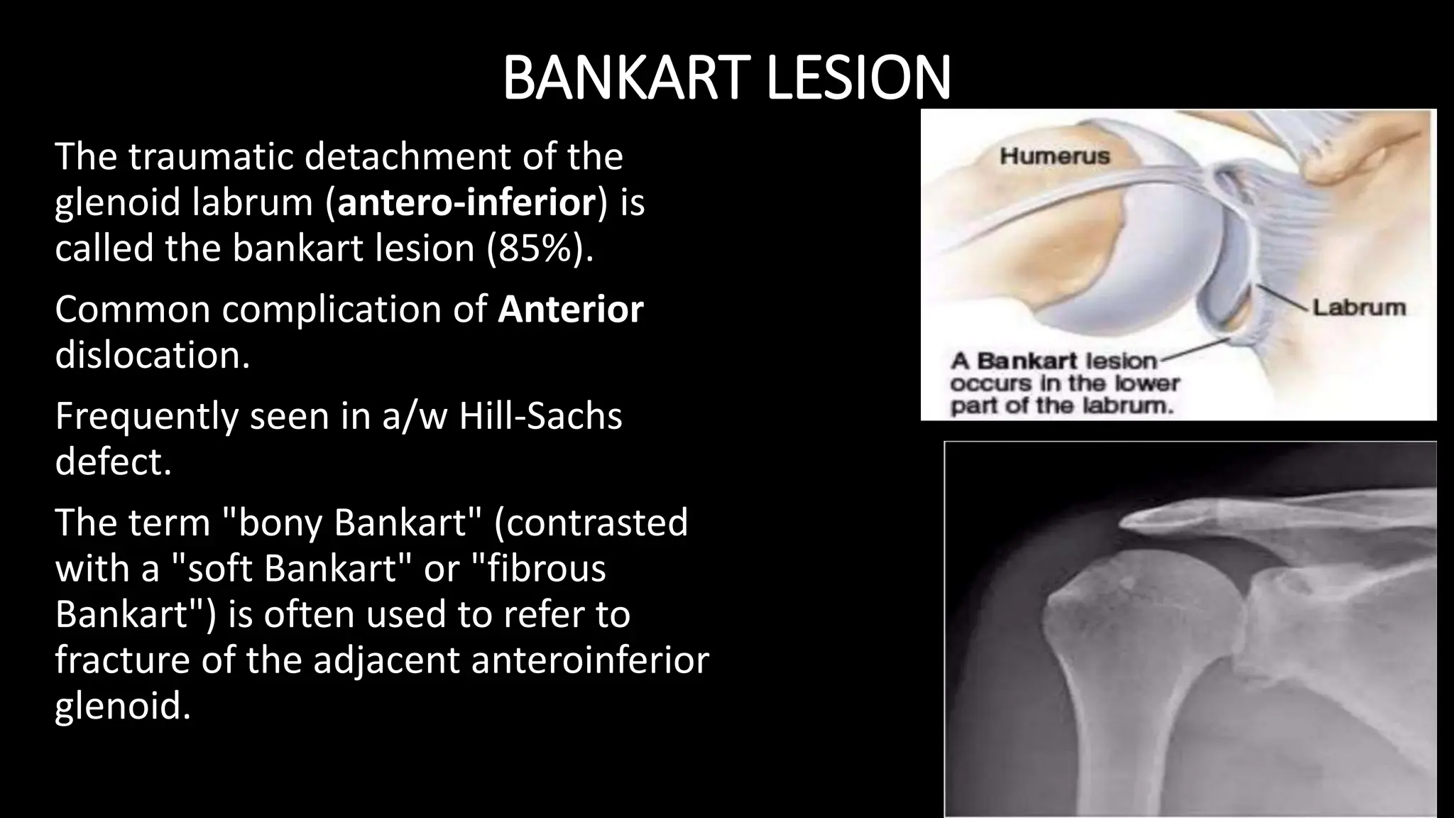 SHOULDER INSTABILITY AIIMS JODHPUR SEMINAR | PPTX