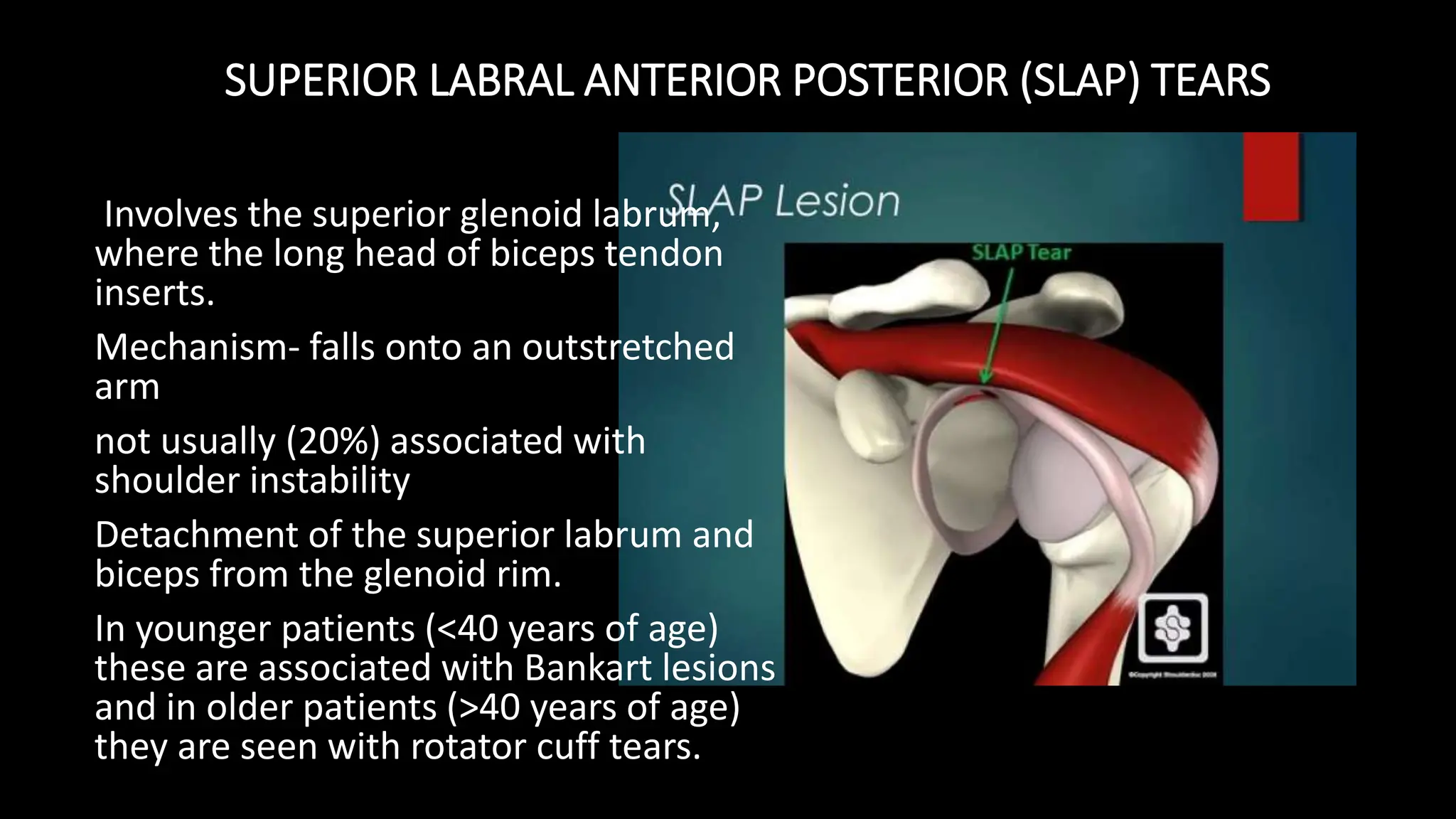 SHOULDER INSTABILITY AIIMS JODHPUR SEMINAR | PPTX