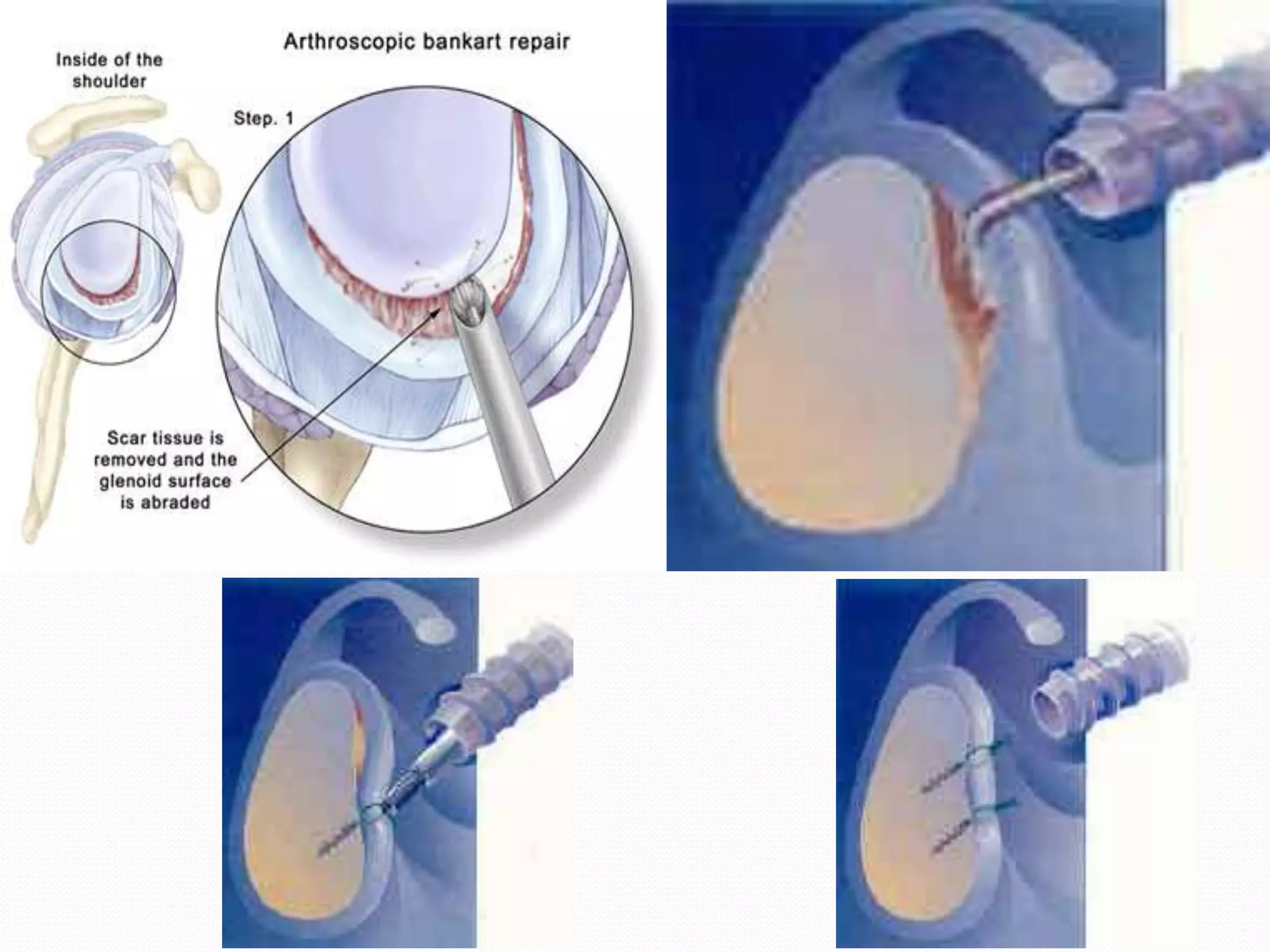 Shoulder instability (anatomy,types, management ) | PPTX