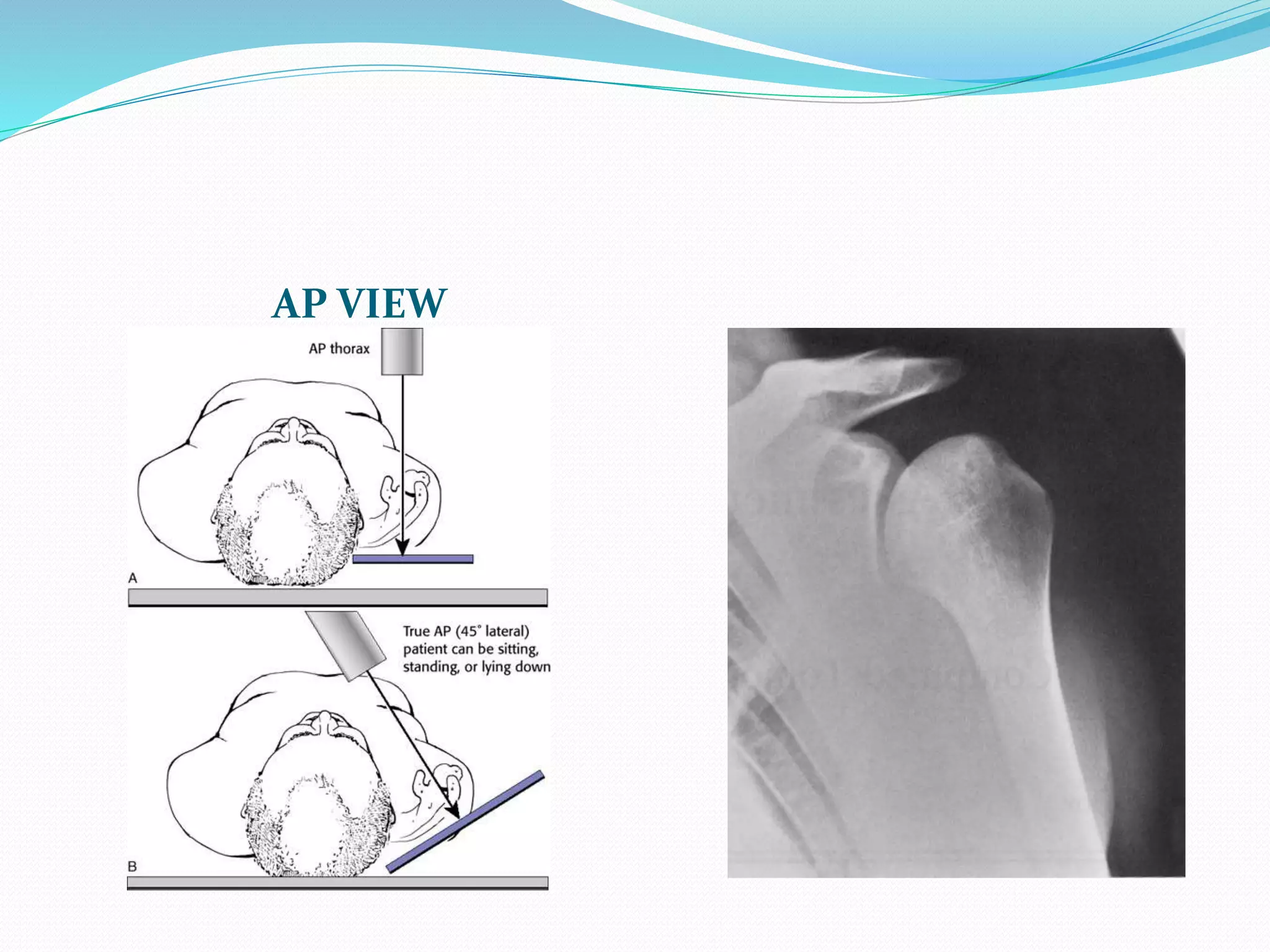 Shoulder instability (anatomy,types, management ) | PPTX