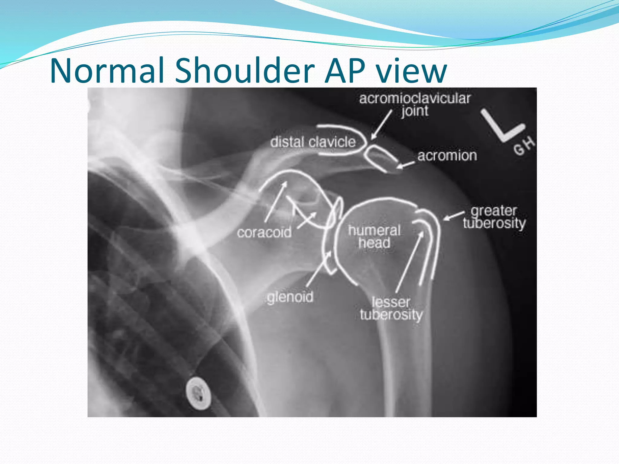 Shoulder instability (anatomy,types, management ) | PPTX