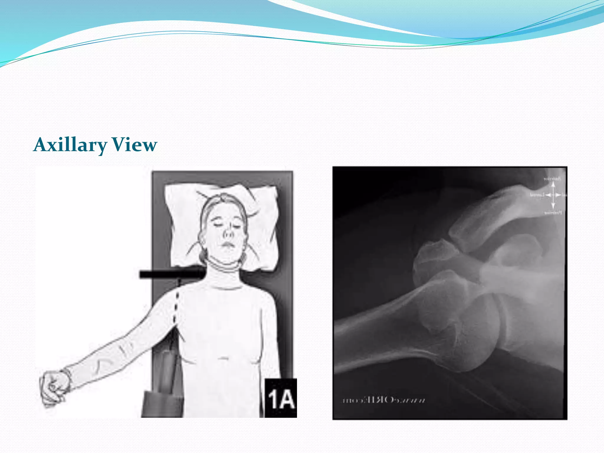 Shoulder instability (anatomy,types, management ) | PPTX