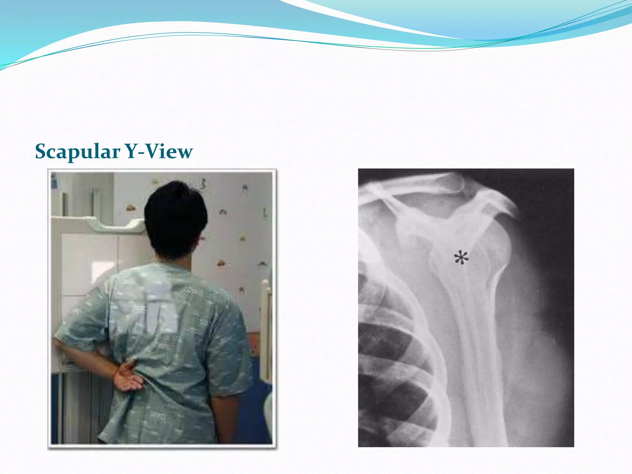Shoulder instability (anatomy,types, management ) | PPTX