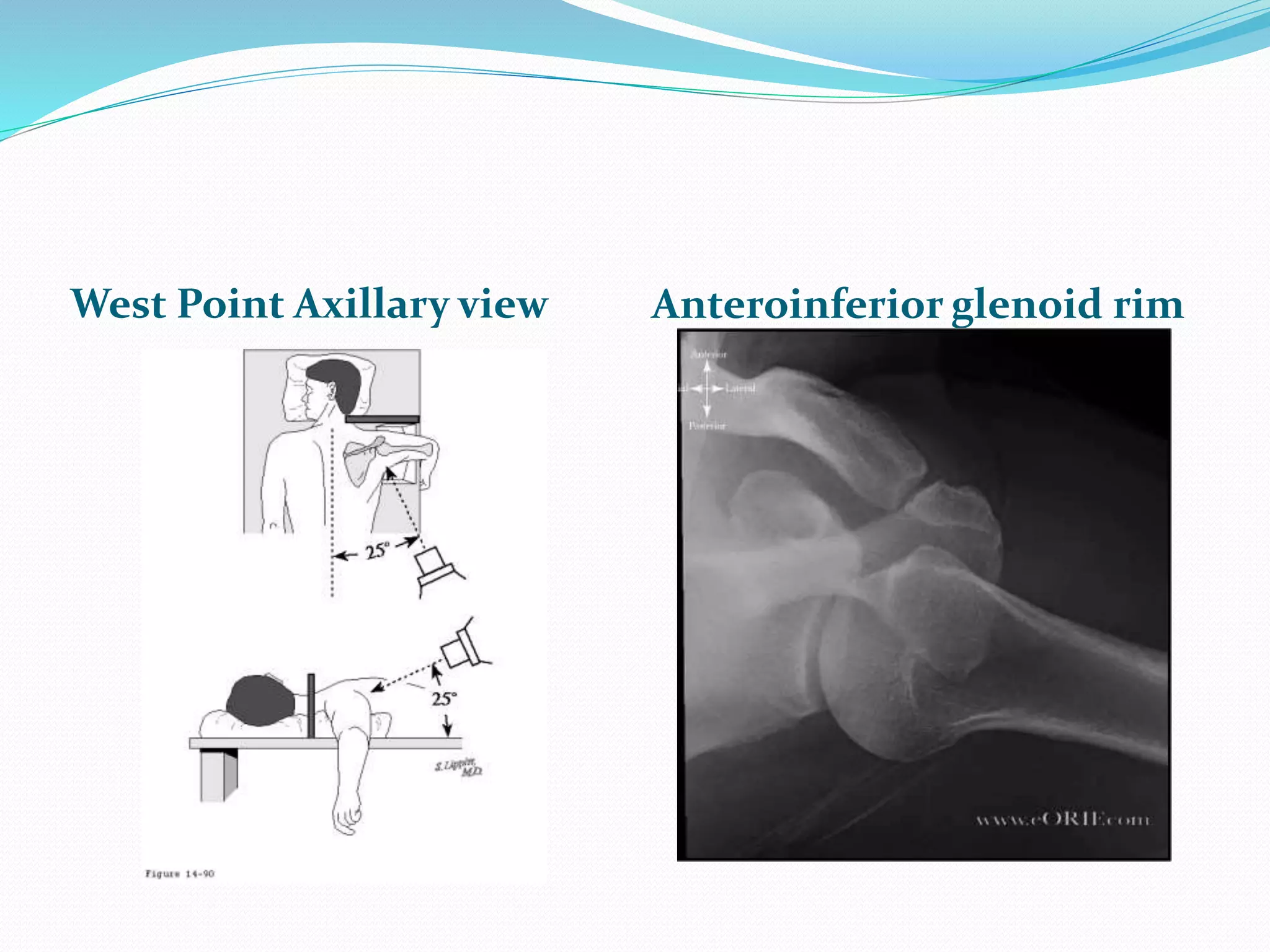 Shoulder instability (anatomy,types, management ) | PPTX