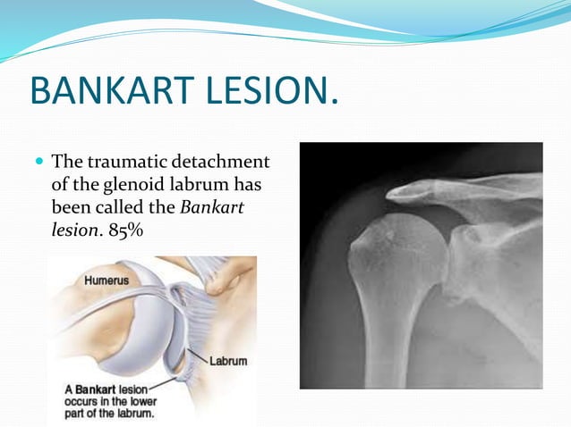 Shoulder instability (anatomy,types, management ) | PPTX