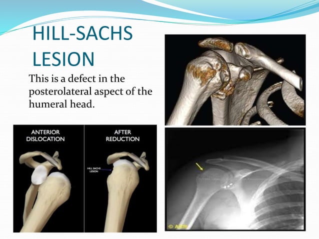 Shoulder instability (anatomy,types, management ) | PPTX