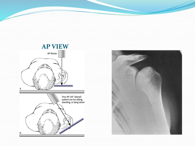 Shoulder instability (anatomy,types, management ) | PPTX