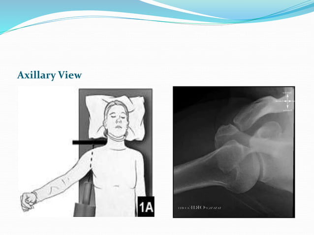 Shoulder instability (anatomy,types, management ) | PPTX