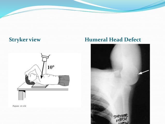 Shoulder instability (anatomy,types, management ) | PPTX