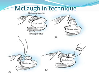 Shoulder instability (anatomy,types, management ) | PPT
