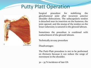 Shoulder instability (anatomy,types, management ) | PPT