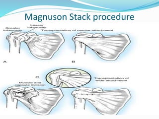 Shoulder instability (anatomy,types, management ) | PPT