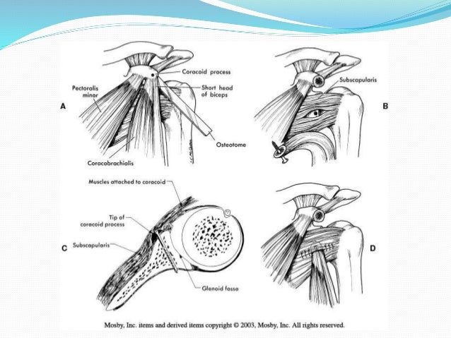 Shoulder instability (anatomy,types, management )