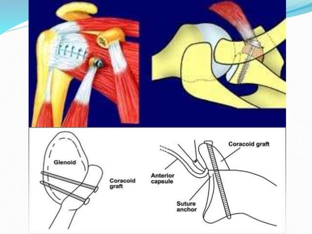 Shoulder instability (anatomy,types, management )