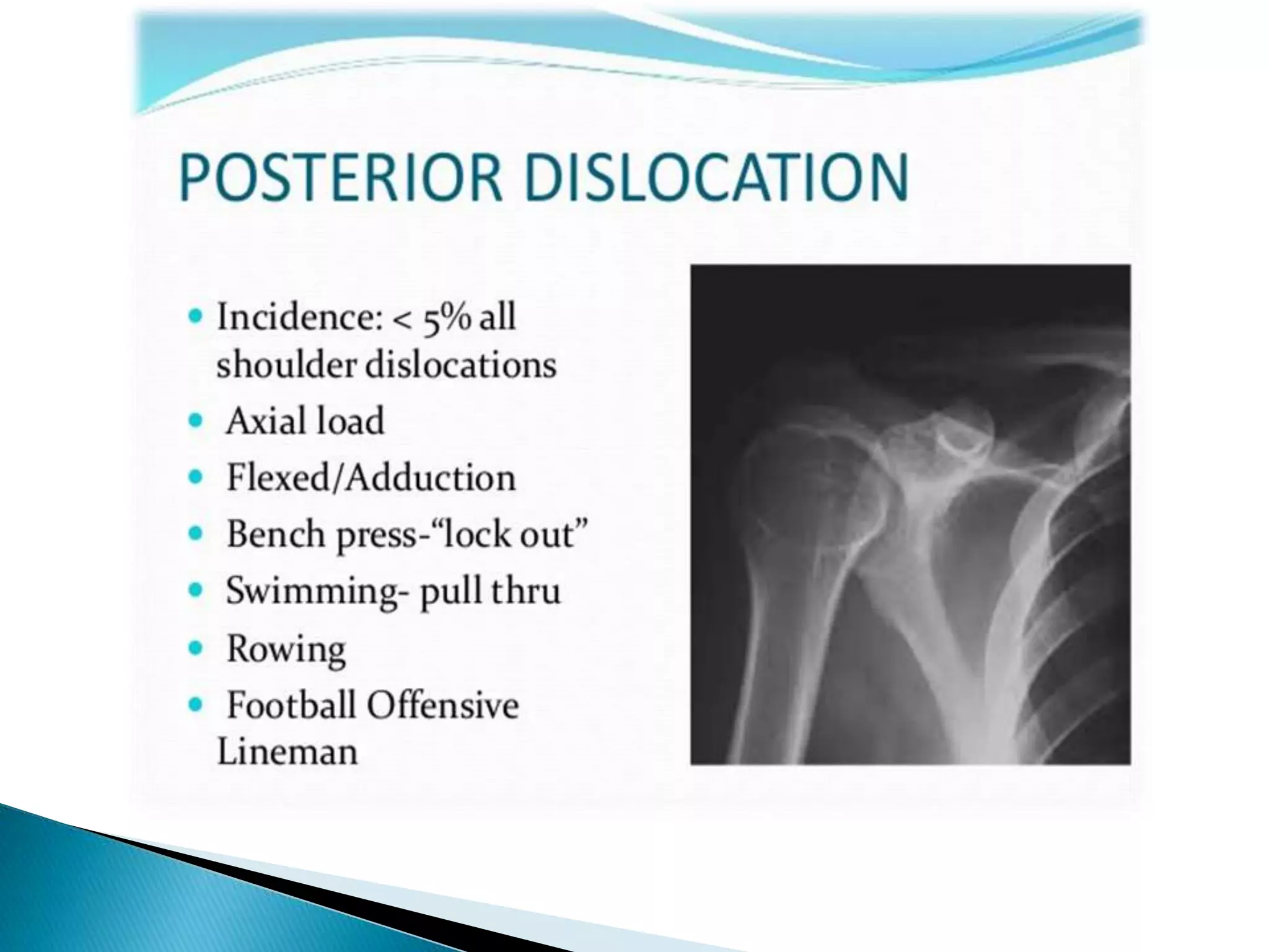 Shoulder instability- anatomy mechanism & treatment | PPT